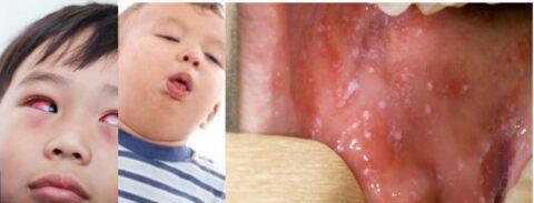 MMR/Measles | North Central London Integrated Care System